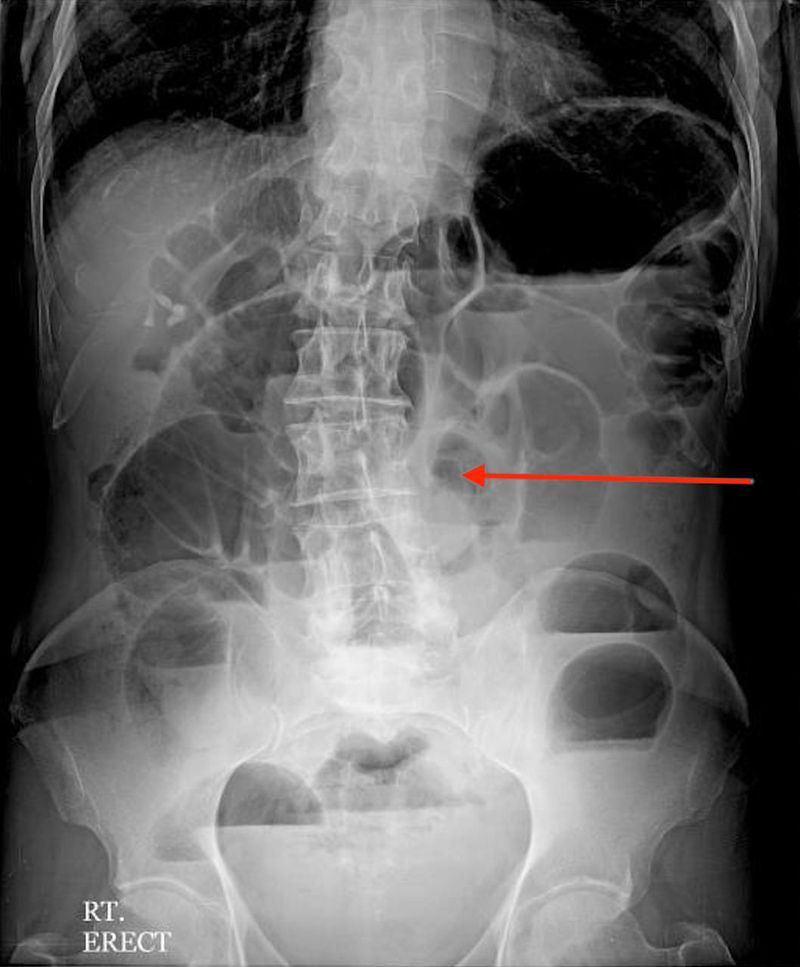 Small Bowel Obstruction X Ray