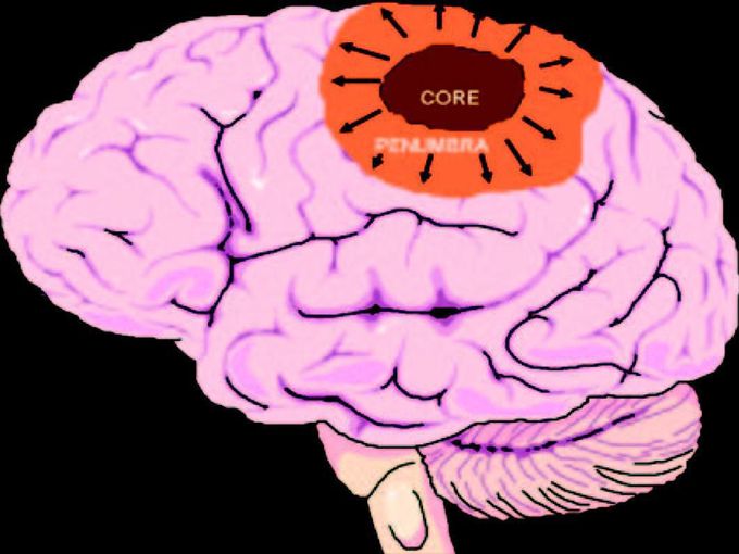 Schematic of brain involvement in acute stroke shows a core - MEDizzy