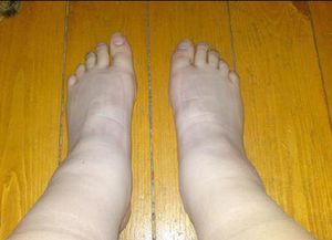 This pt admitted with of bilateral lower limb pitting edema, - MEDizzy