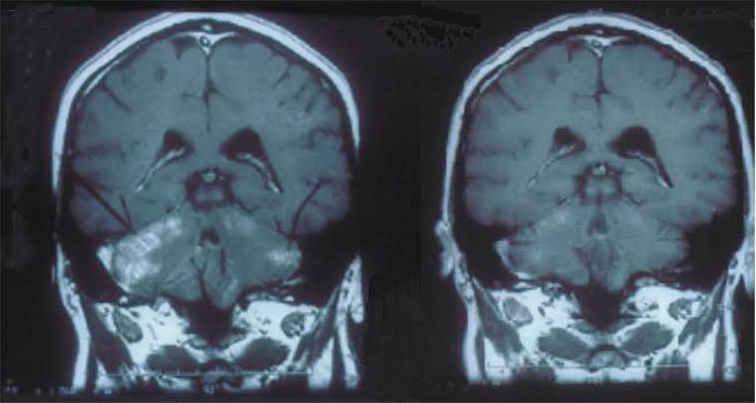 Symptoms of Neurosarcoidosis - MEDizzy
