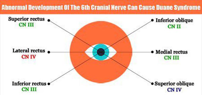 Abnormal development of 6th cranial nerve that can cause - MEDizzy