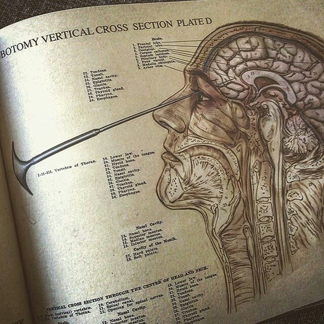 Lobotomy Diagram