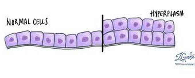 Hyperplasia - MEDizzy