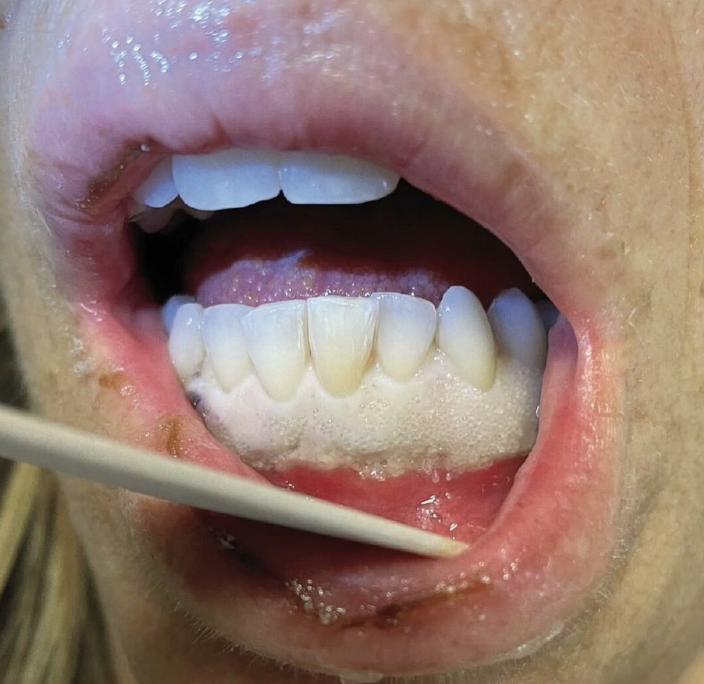 Completely White Gums MEDizzy