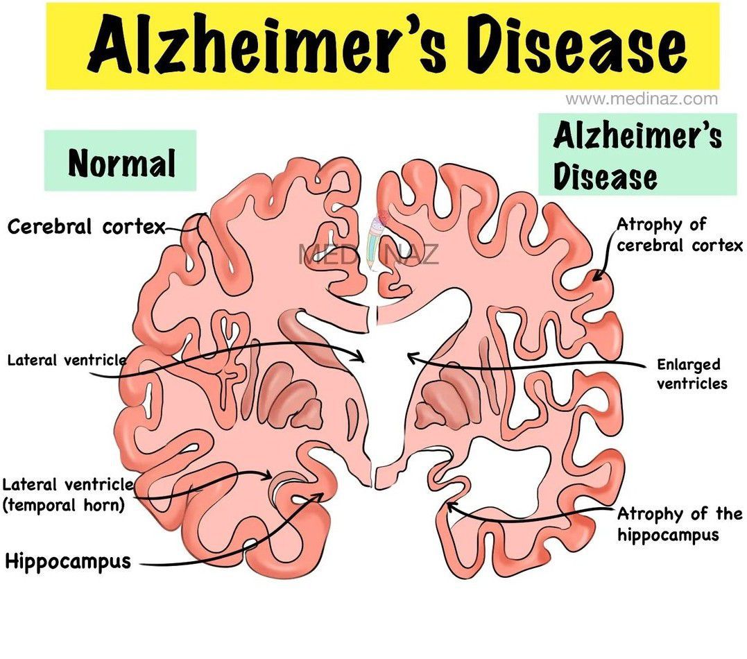 Normal Vs Alzheimer s Brain MEDizzy