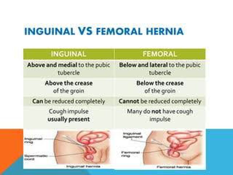 Inguinal And Femoral Hernia L14.jpg