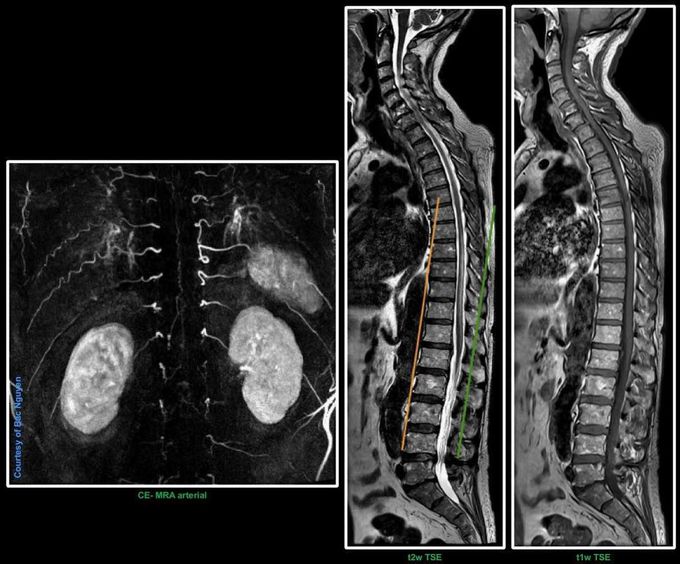 Spinal Arteriovenous Malformation (AVM) @ Siemens 3T - MEDizzy