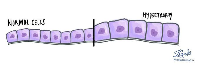 Hypertrophy - MEDizzy