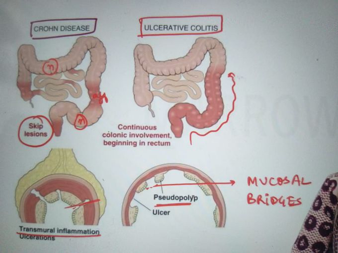 Crohn disease and ulcerative colitis - MEDizzy