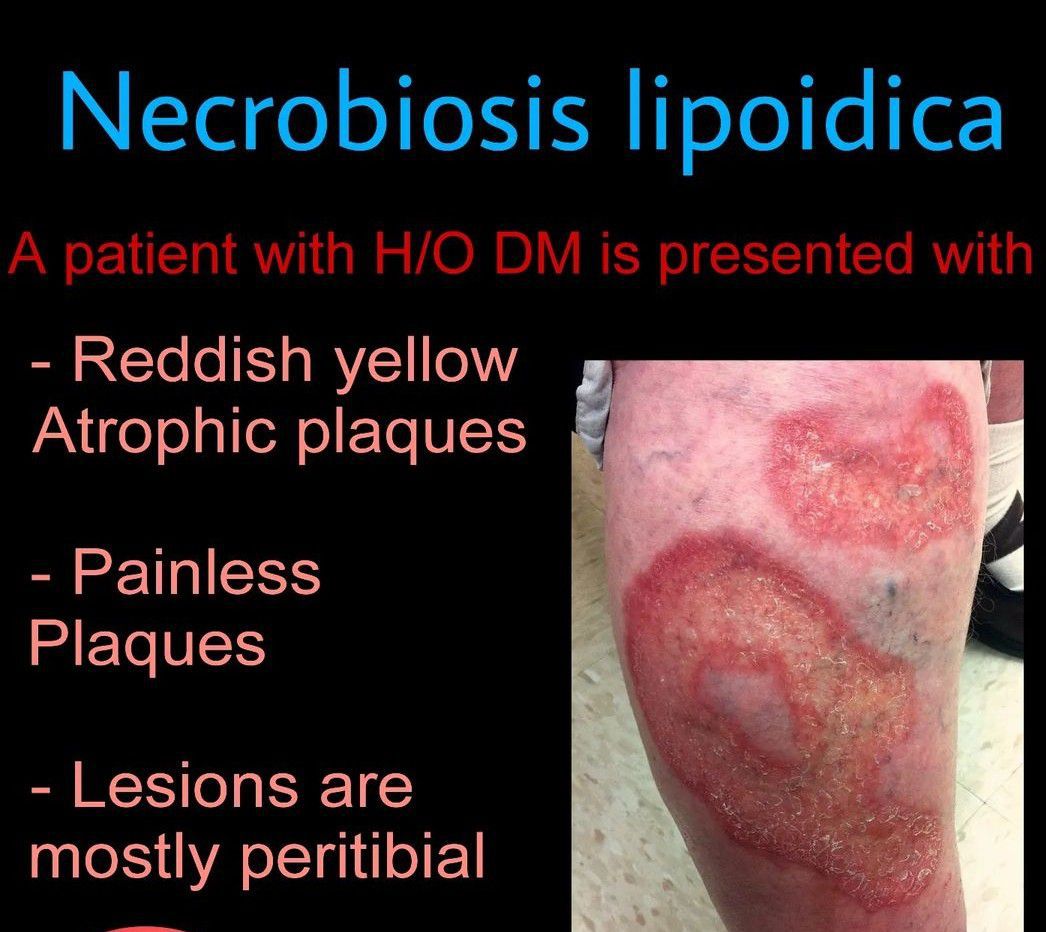 Necrobiosis Lipoidica Diabeticorum Necrobiosis Lipoidica Clinical