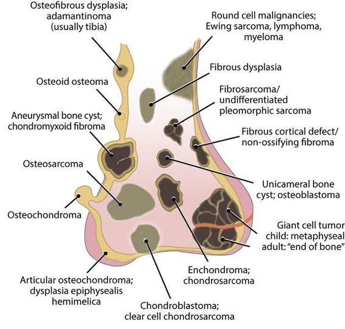 Primary Bone Tumor - MEDizzy
