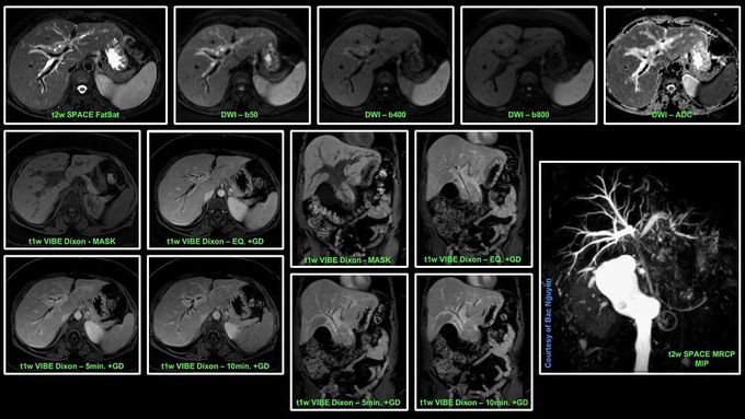 cholangiocarcinoma @ Siemens 3T Skyra #Siemens_MRI #siemens - MEDizzy