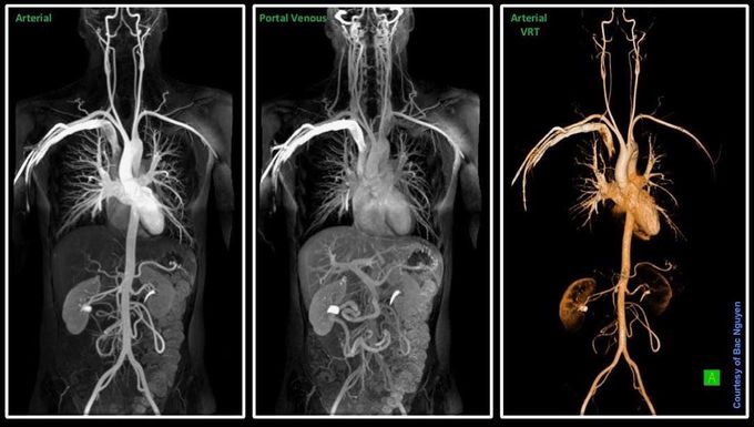 Contrast Enhanced MRA (CE-MRA) – Gadovist @ Siemens 1.5T - MEDizzy