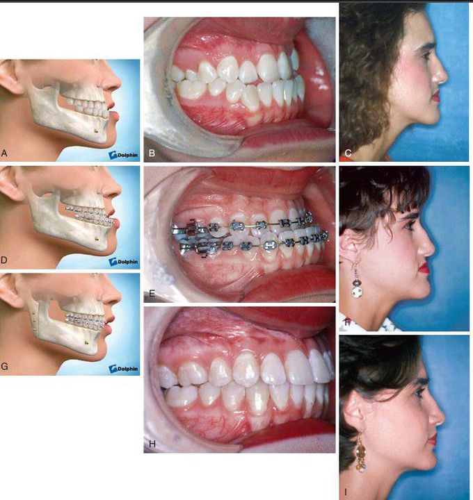 Class III skeletal malocclusion treatment - MEDizzy