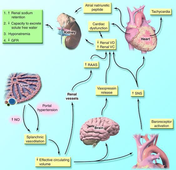 Hepatorenal syndrome - MEDizzy