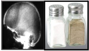 Learn #salt_pepper_skull in #hyperparathyroidism. - MEDizzy