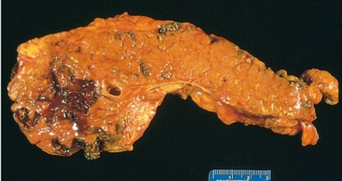 Pancreatitis - MEDizzy