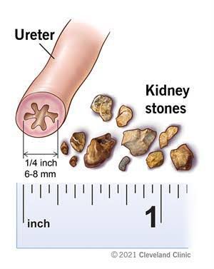 Treating and preventing kidney stones - MEDizzy