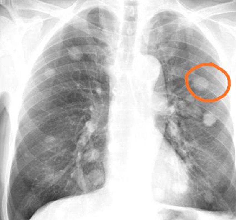 Chest Xray - MEDizzy