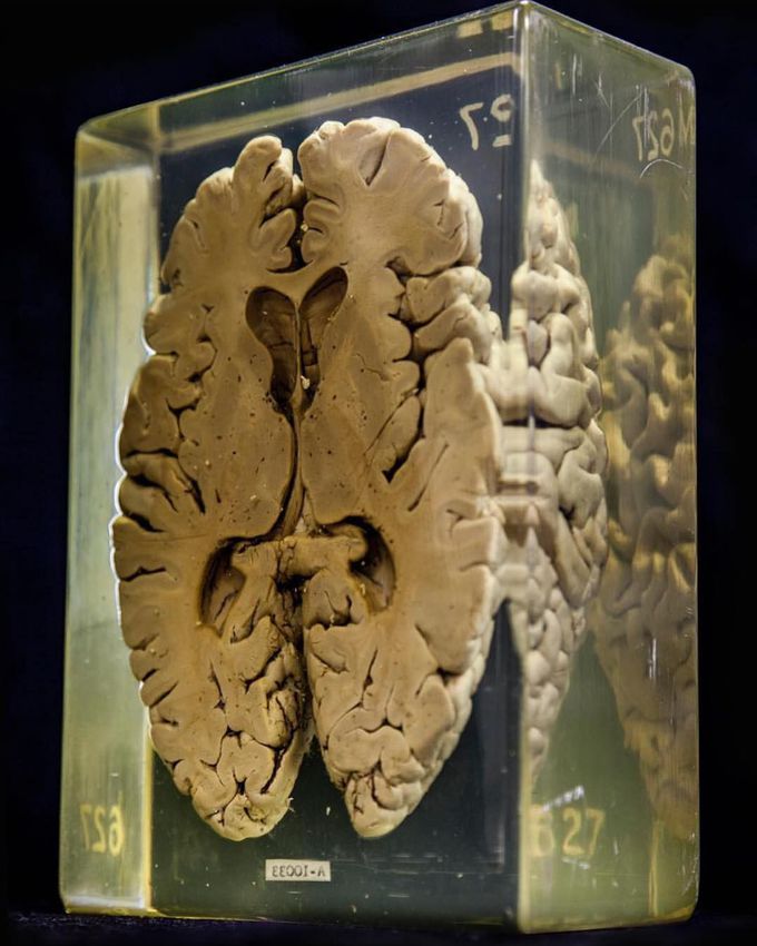 Brain slice - MEDizzy