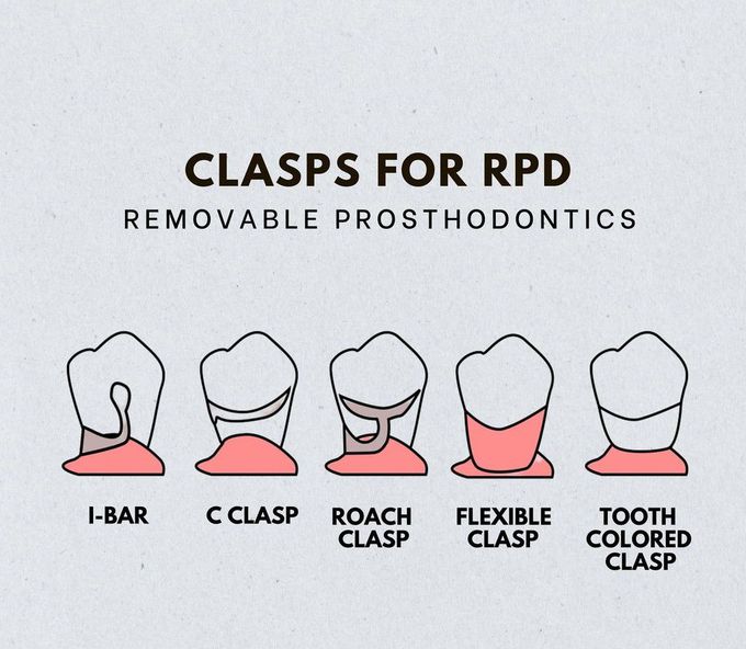 Clasps for RPD - MEDizzy