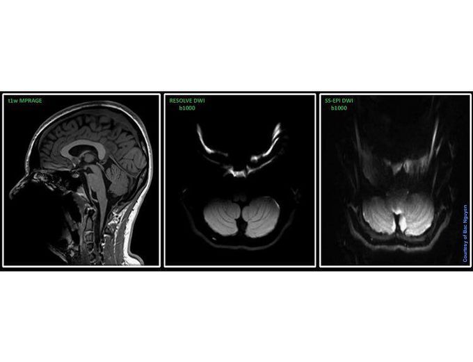 RESOLVE DWI – Metal Artifact Reduction @ Siemens 3T - MEDizzy