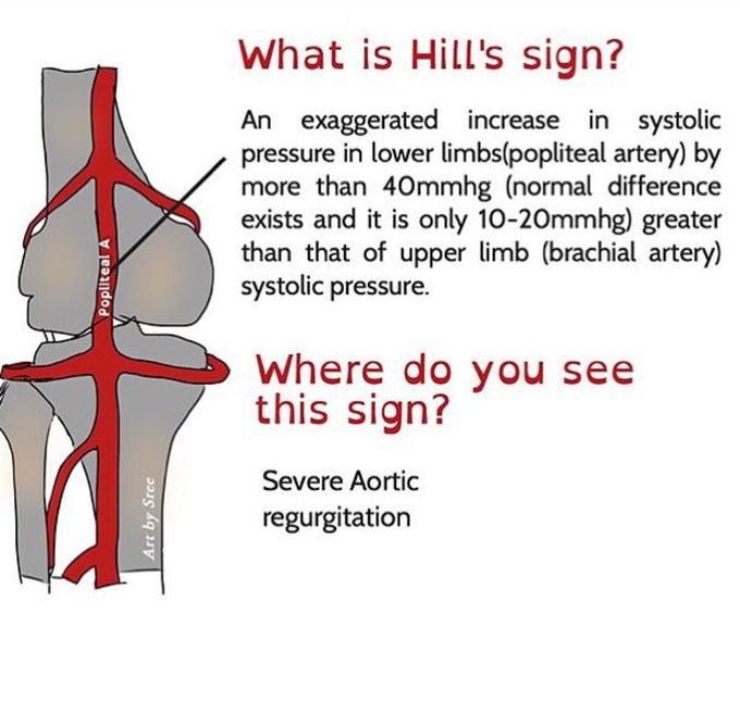 Severe Aortic Regurgitation - MEDizzy
