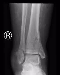 Pilon fracture - MEDizzy