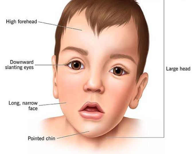 These Are The Symptoms Of Charge s Syndrome MEDizzy