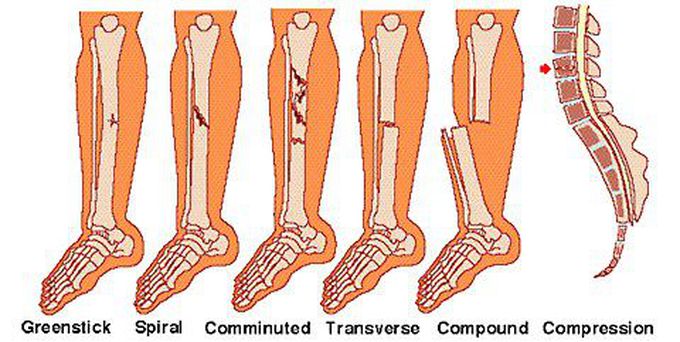 Typical Bone Fracture - MEDizzy