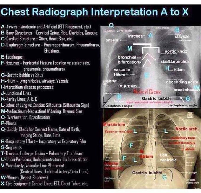 Chest radiograph - MEDizzy