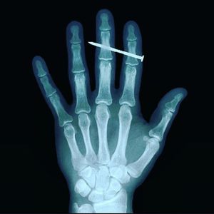 Nail through the middle Phalange of the Middle finger. - MEDizzy