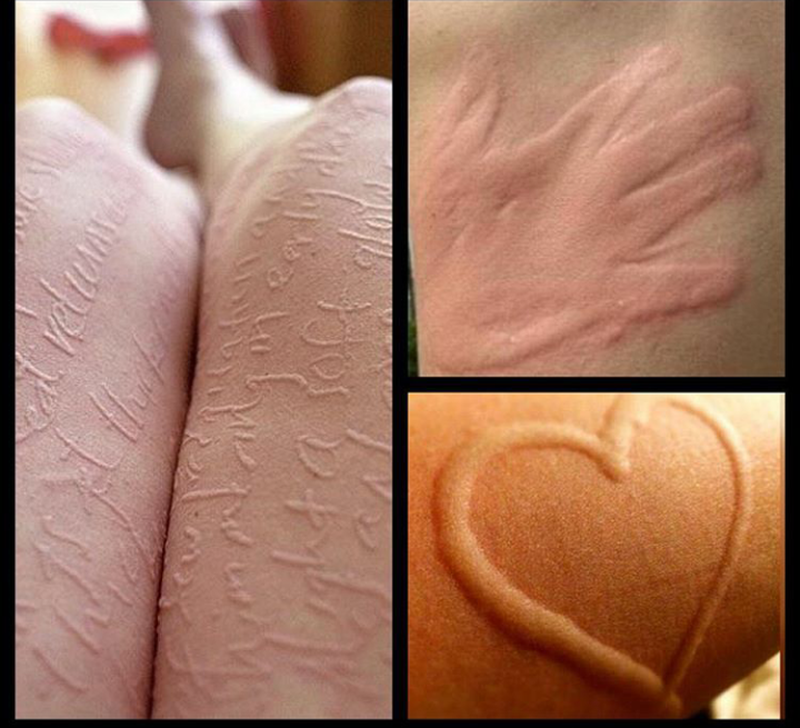 Dermatographia MEDizzy