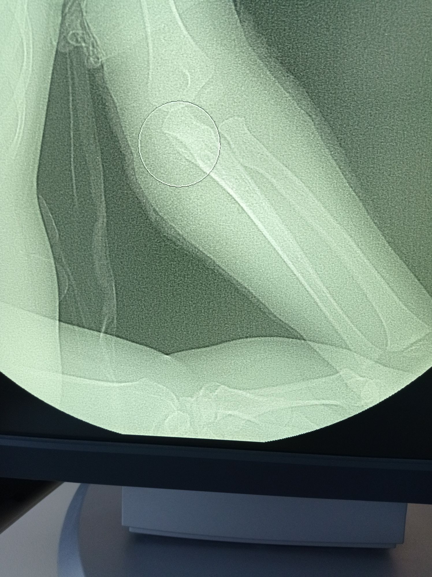 Acute periostitis of ulna - MEDizzy
