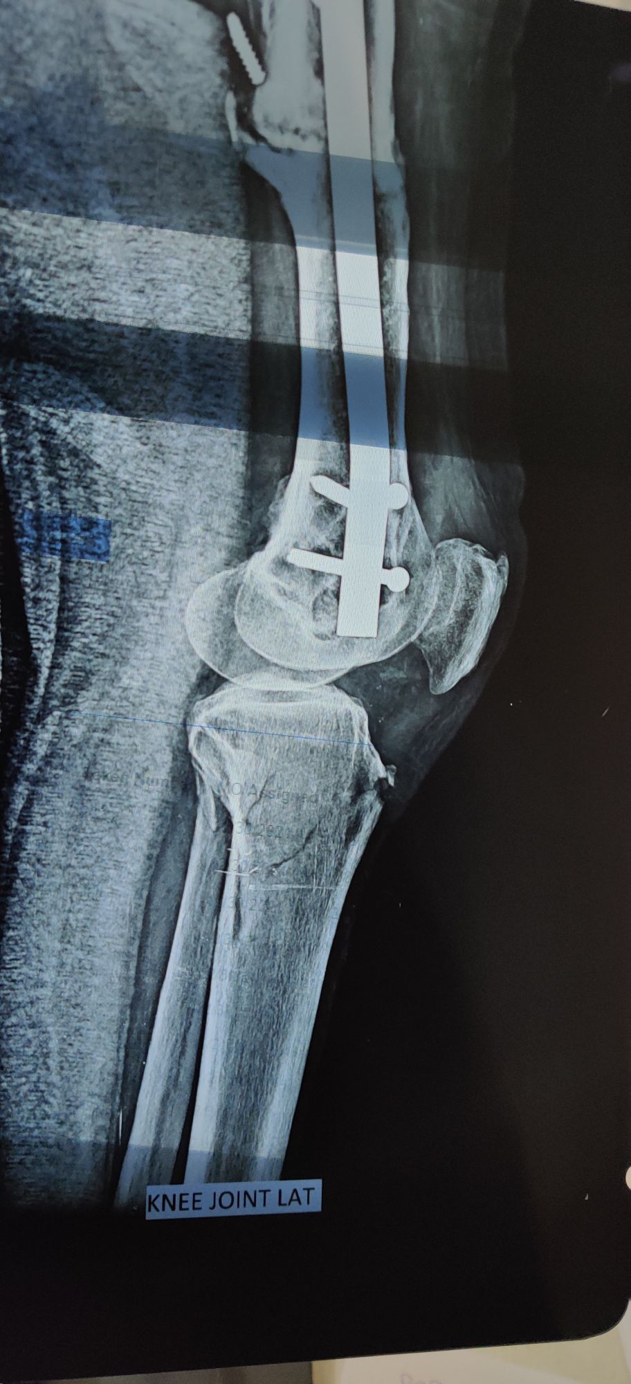 Intramedullary Nailing of Femur with Fx of Tibia - MEDizzy