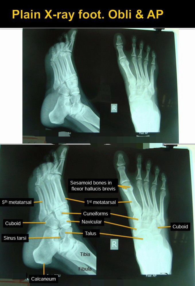 Foot X-ray - MEDizzy