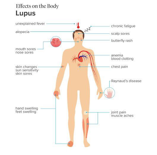 Symptoms of lupus. - MEDizzy