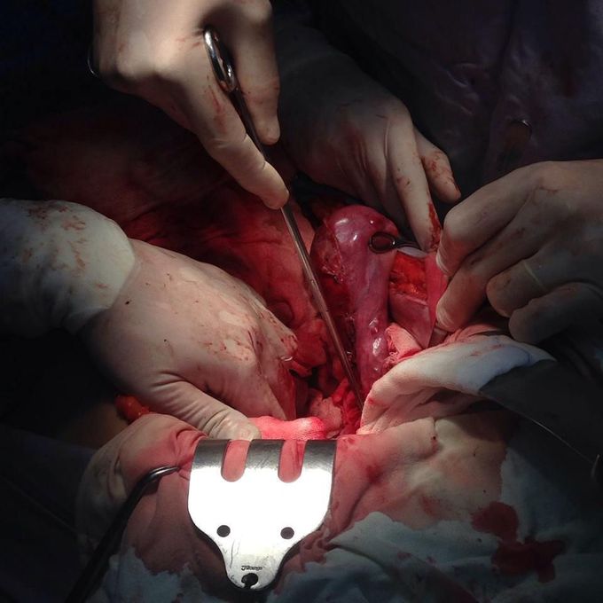 Pancreatectomy: surgical removal of the pancreas or parts of - MEDizzy