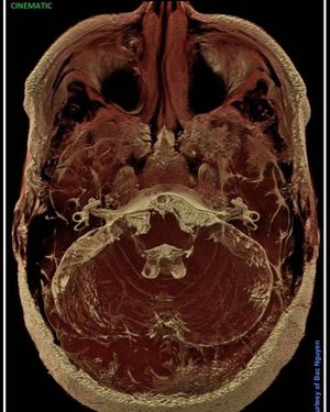 Internal Acoustic Canal (IAC) - MEDizzy