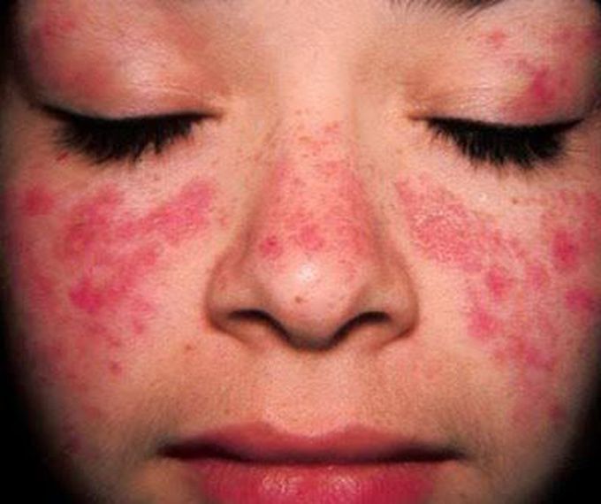 SLE symptoms - MEDizzy