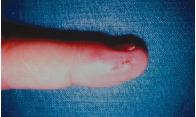 Herpetic whitlow - MEDizzy