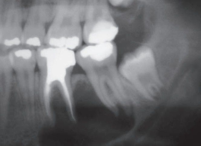 Periapical cyst bitewing x ray - MEDizzy