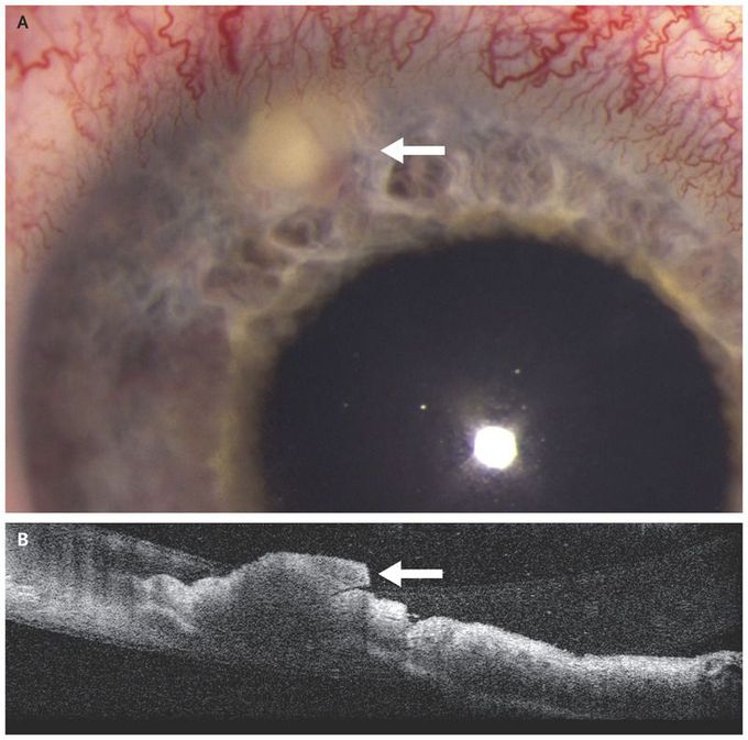 Iris Abscess - MEDizzy