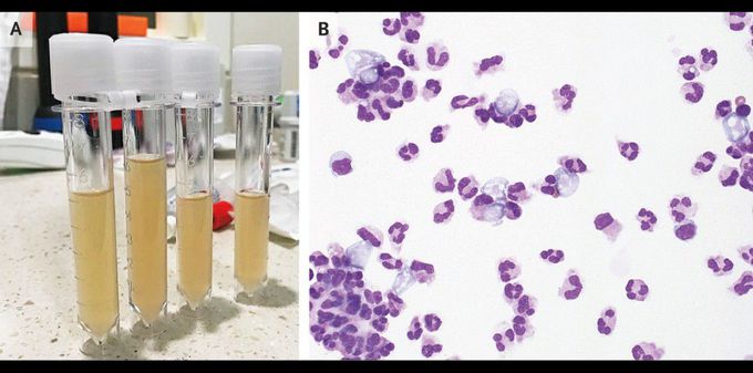 Naegleria fowleri - MEDizzy