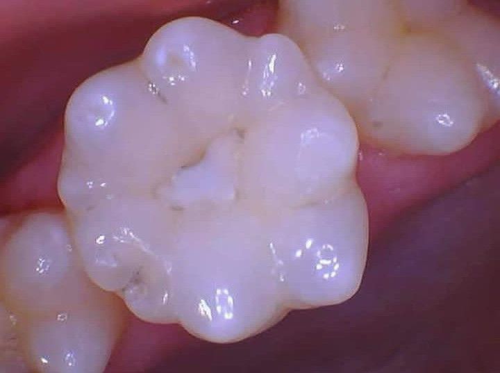 Congenital Syphilis Mulberry Molars