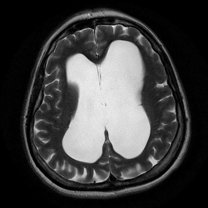 An MRI showing extremely dilated ventricles! - MEDizzy