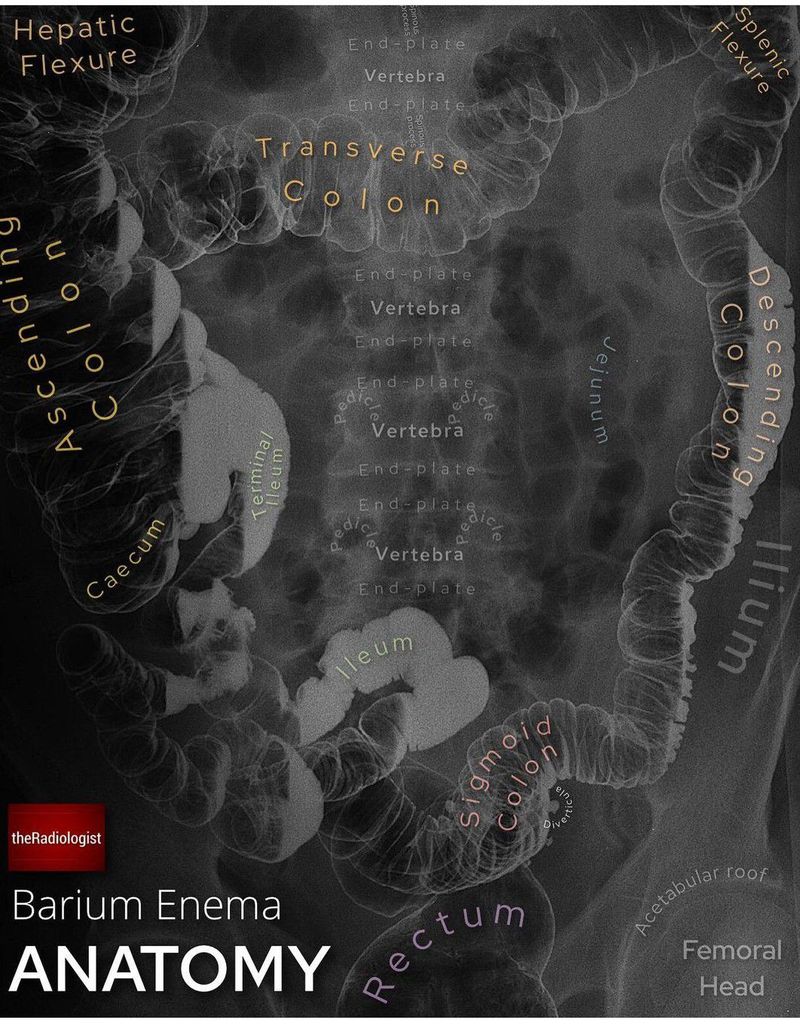 Intussusception Claw Sign