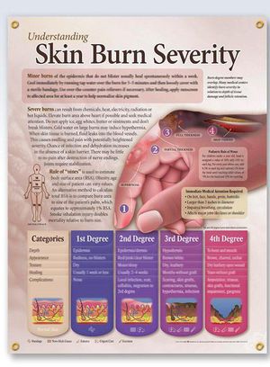 Types of skin burns and their cure . - MEDizzy