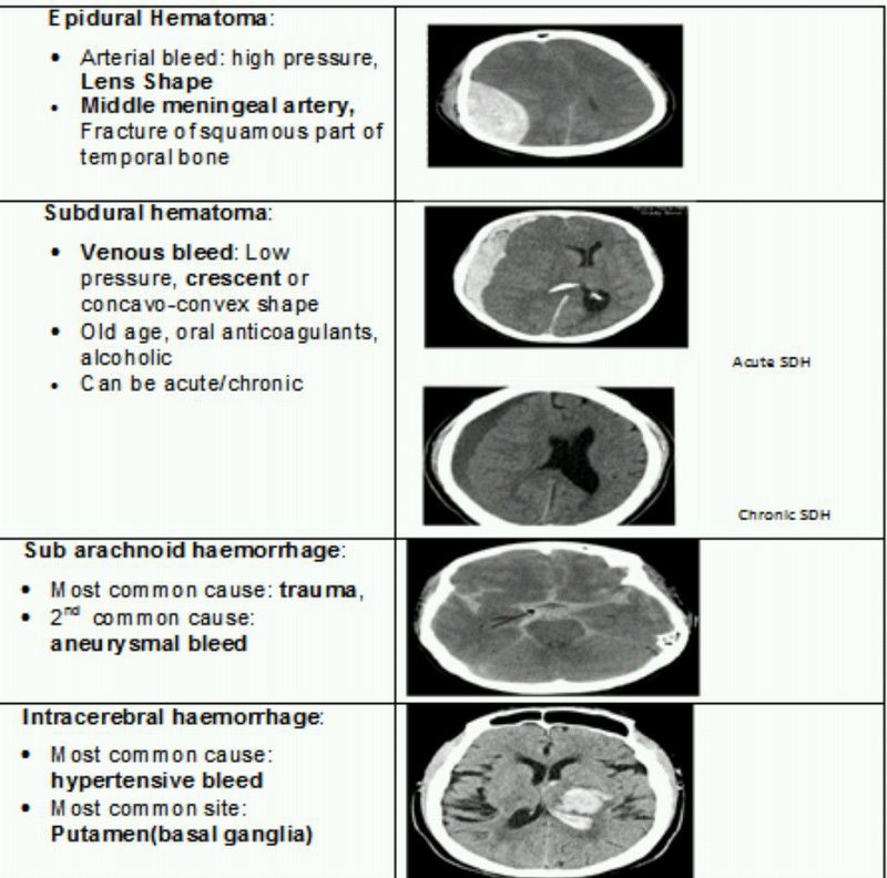 Intracranial bleed - MEDizzy