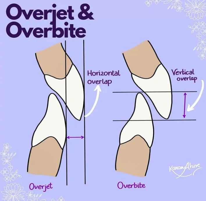 Overjet And Overbite MEDizzy